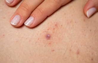 Cabello encarnado vs. grano: ¿cuál es la diferencia?