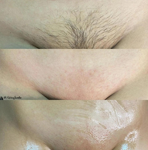 Vajacial Treatment 101: Everything Explained