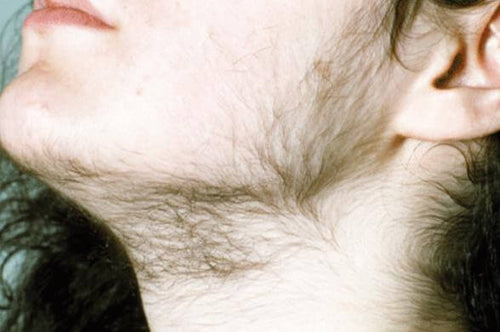 Hypertrichosis (Werewolf Syndrome): Definition, Types, Causes, and Tre
