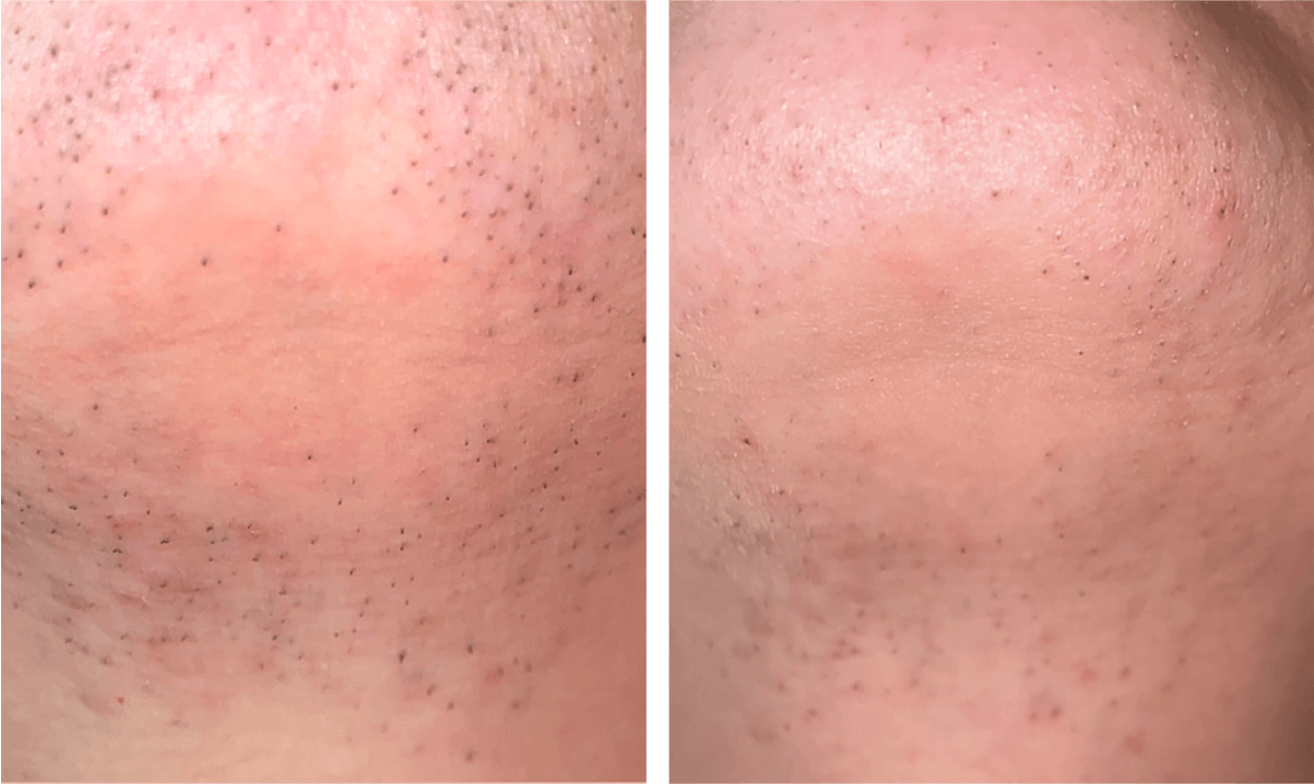 Ulike Air 10 IPL Laser Hair Removal Device