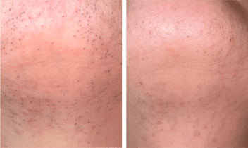 Ulike Air 10™ Official | IPL Laser Hair Removal Device