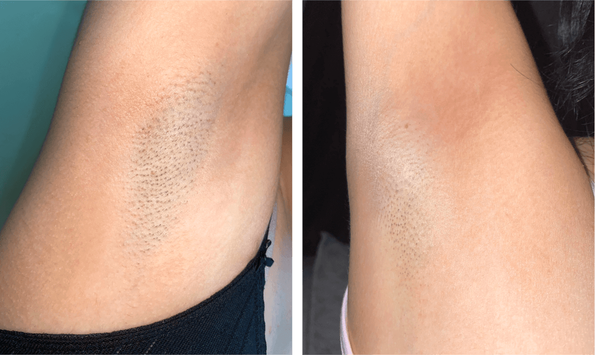 Ulike Air 10 IPL Laser Hair Removal Device