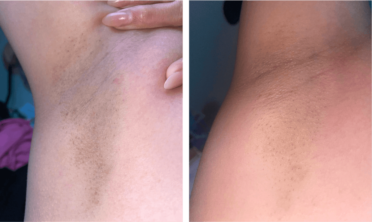 Ulike Air 10 IPL Laser Hair Removal Device