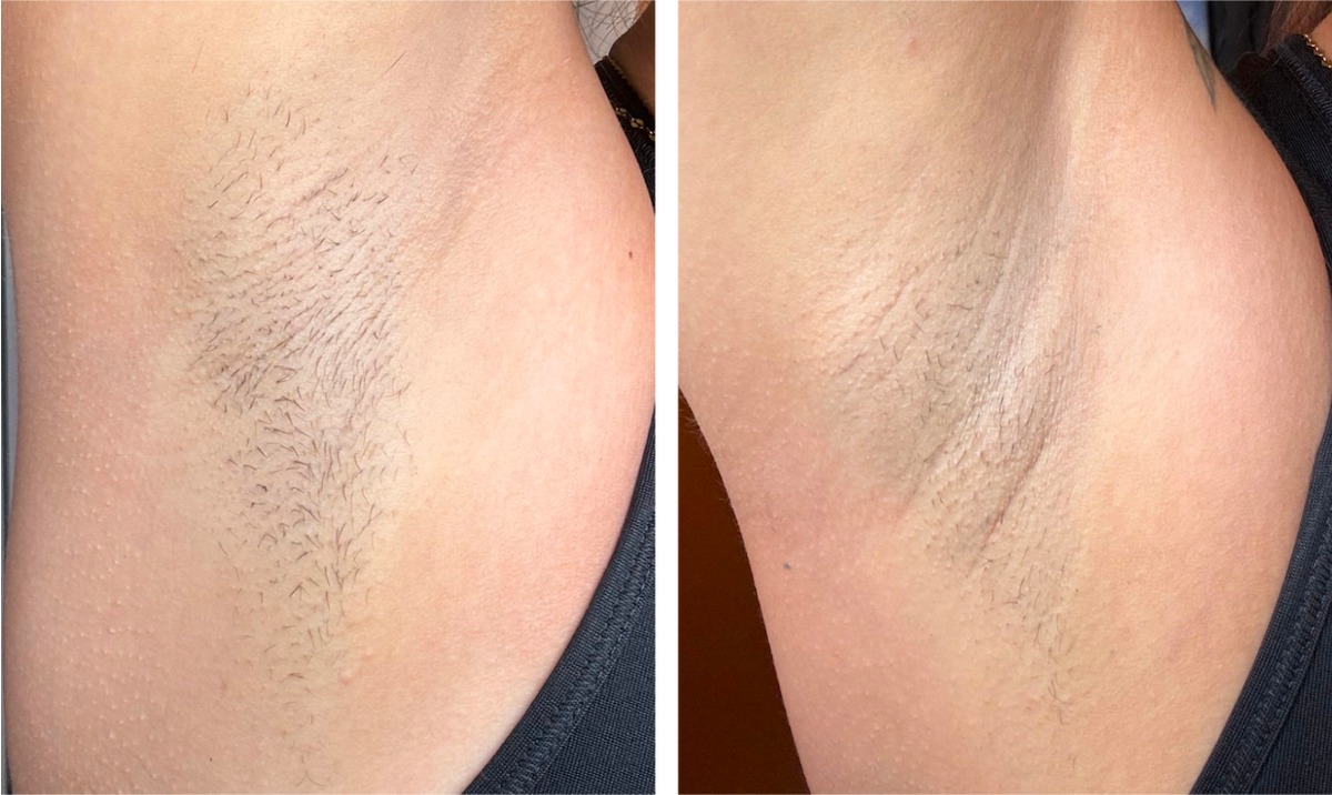 Ulike Air 10 IPL Laser Hair Removal Device