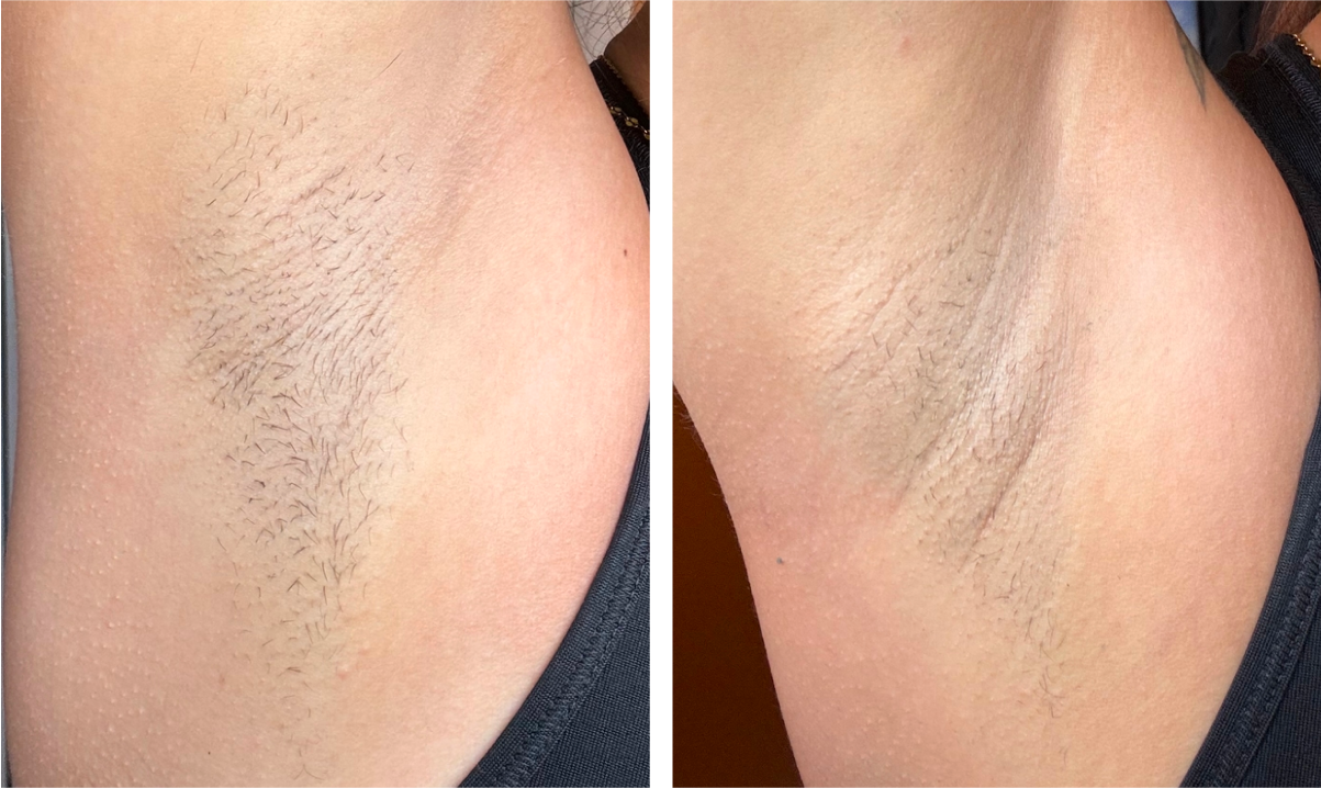 Ulike Air 10 IPL Laser Hair Removal Device